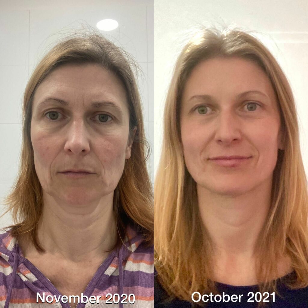 Before After Face Fitness Coach And Face Yoga Therapist